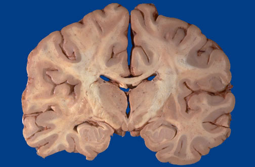 MedFriendly Medical Blog: Neurocysticercosis: Tapeworm Infestation of ...