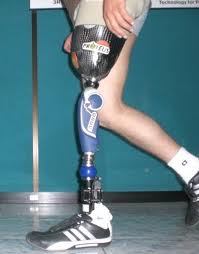 avances tecnologicos de la medicina: prótesis mas avanzadas