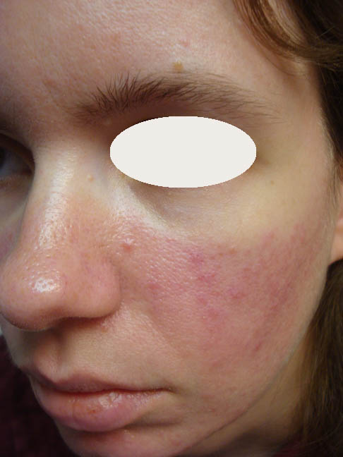 VIRTUAL GRAND ROUNDS IN DERMATOLOGY 2.0: An Unusual Case of Scalp ...