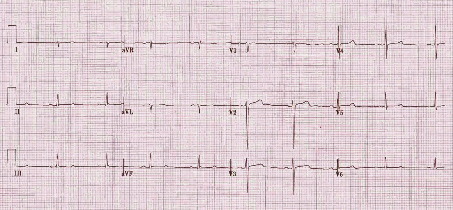 Left Posterior Fascicular Block | INA - ECG