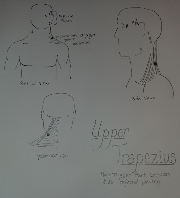 Trigger Point: Upper Trapezius