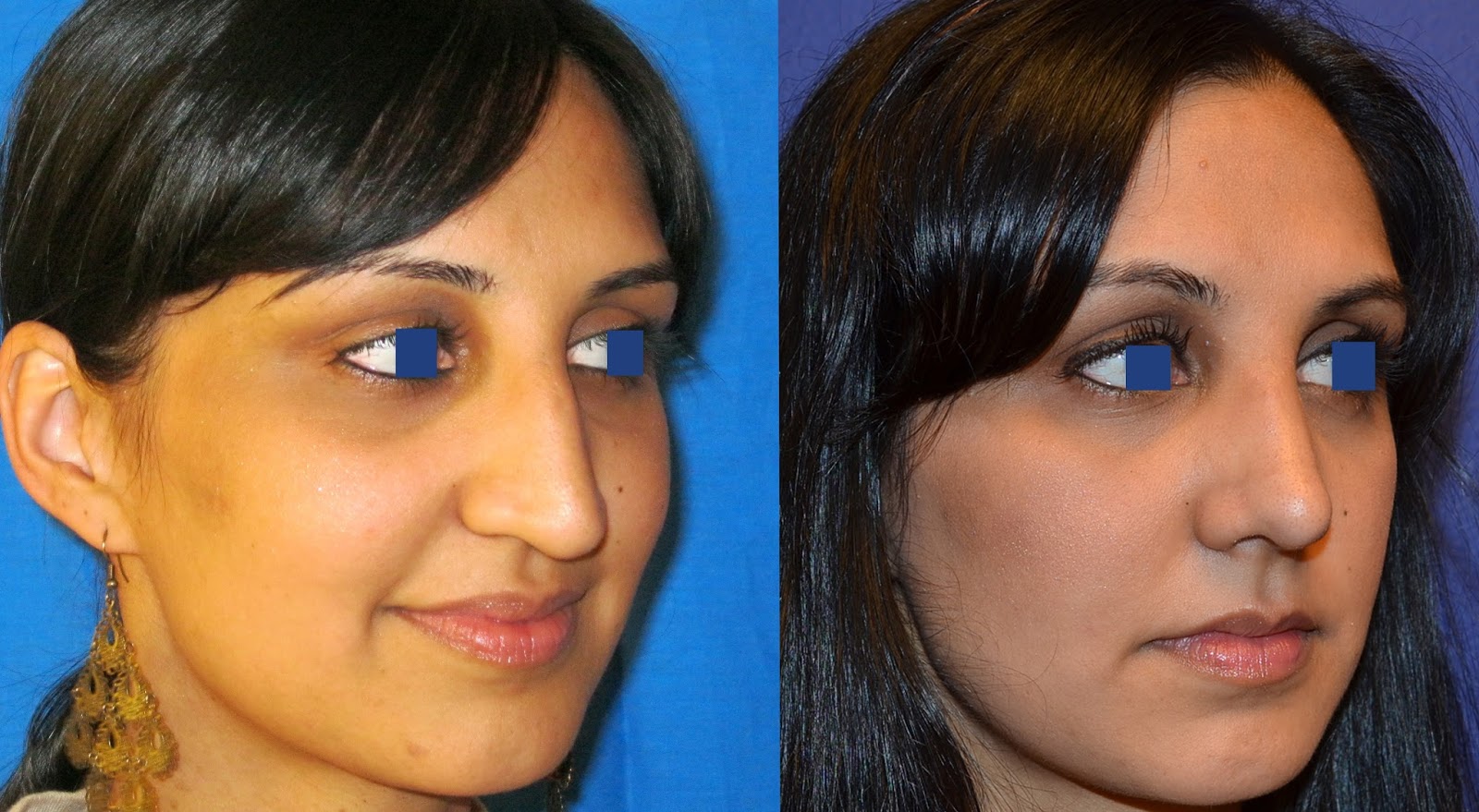 Cosmetic Rhinoplasty - Ethnic Rhinoplasty - Septoplasty