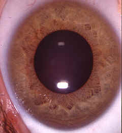 Images For Kayser Fleischer (KF) Ring - Wilson's Disease ~ YOUNG ...