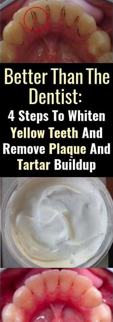 Better Than The Dentist: 4 Steps To Whiten Yellow Teeth And Remove ...