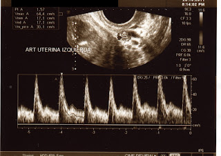 Medicina Materno Fetal: Arterias Uterinas, Preeclampsia y RCIU
