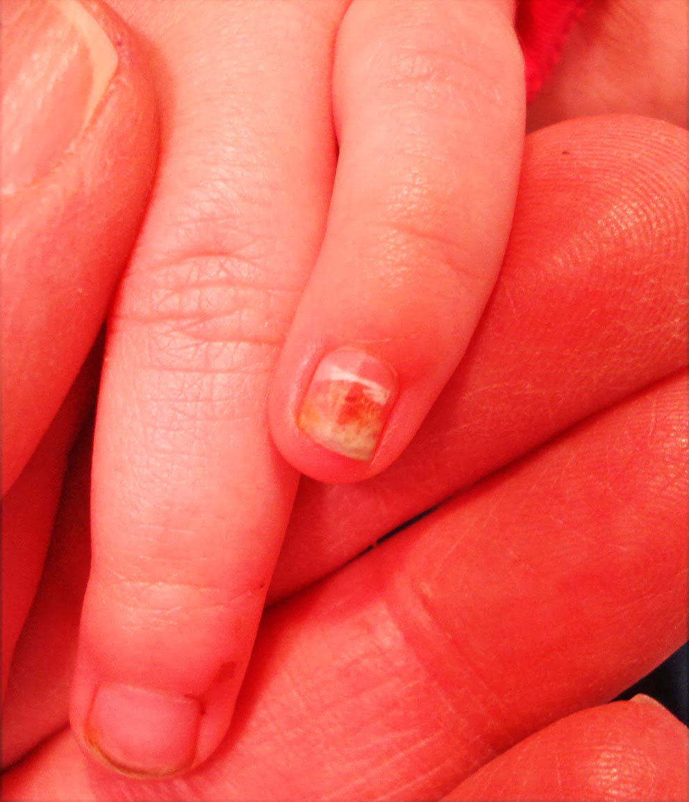 VIRTUAL GRAND ROUNDS IN DERMATOLOGY 2.0: Periodic Shedding of the Nails