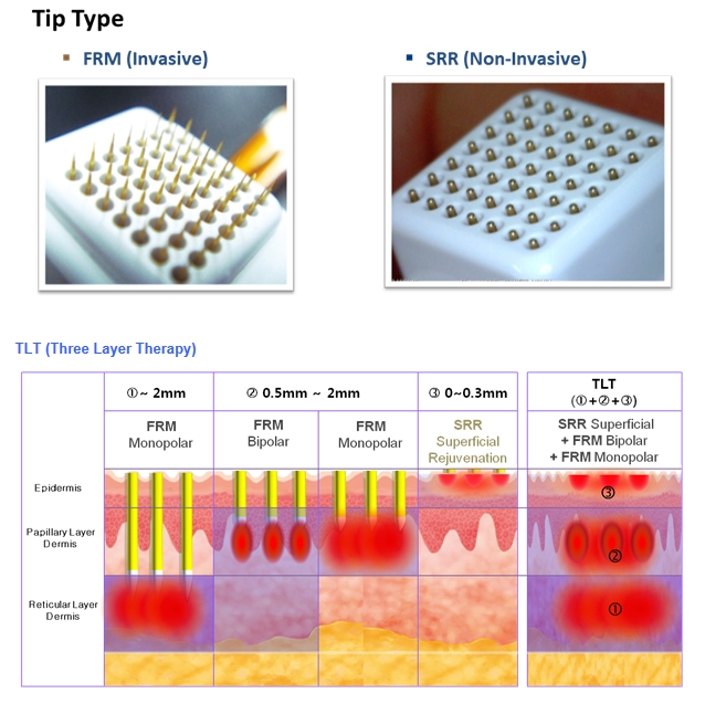 Jeisys: LIFTING/TIGHTENING - Jeisys, INTRAcel, AntiLax
