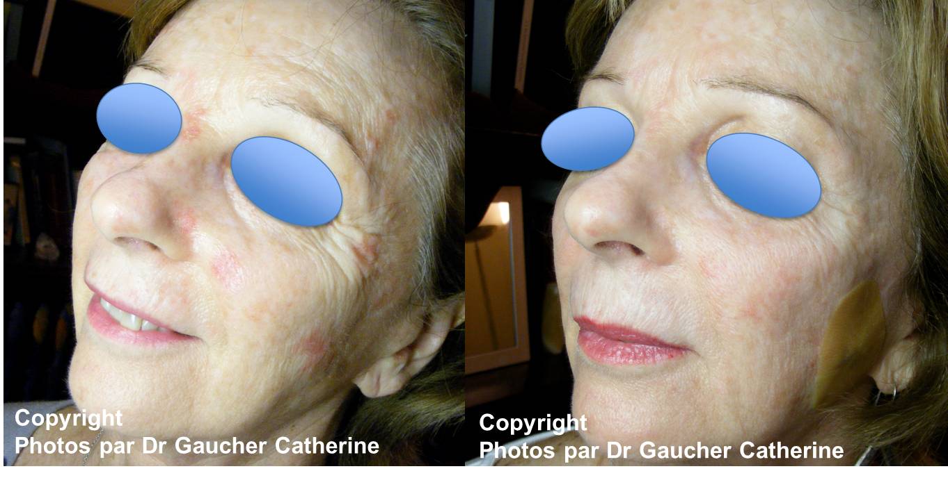 LED ACADEMY: Cas de Photothérapie Dynamique