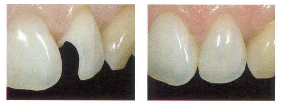 drgRudy.com : TAMBALAN ESTETIK KOMPOSIT / TAMBALAN LASER