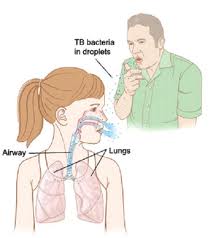 Project in Human Anatomy and Physiology: TUBERCULOSIS