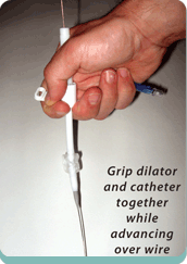 Procedures Club: Surgical Airway, Part One: Cricothyrotomy