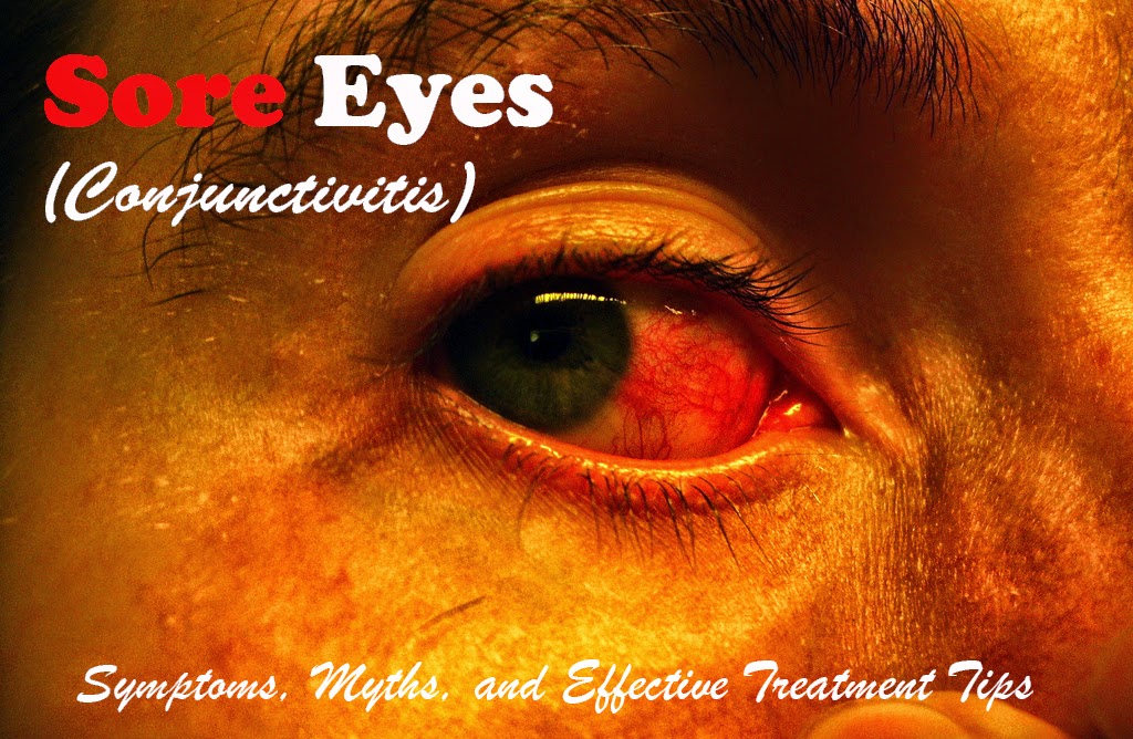 Sore Eyes (Conjunctivitis) Symptoms, Myths, and Effective Treatment ...
