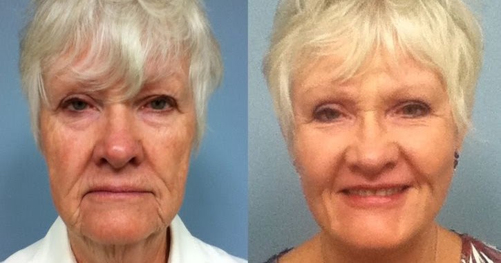 Non-Invasive And Natural Facelifts Using Face Aerobics Exercises: Face ...