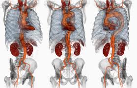 Aortic dissection | Diseases Pedia