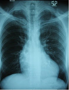 Aortic Root Replacement with Composite valve graft conduit for Aortic ...