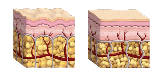 BEJIINE*S: Cellulite Killers : Cellu-Cup vs Cellublue