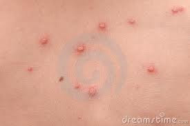 HEALTHYLOG: Varicela