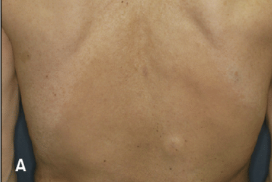 Cancer Continuum: My Diagnosis Story