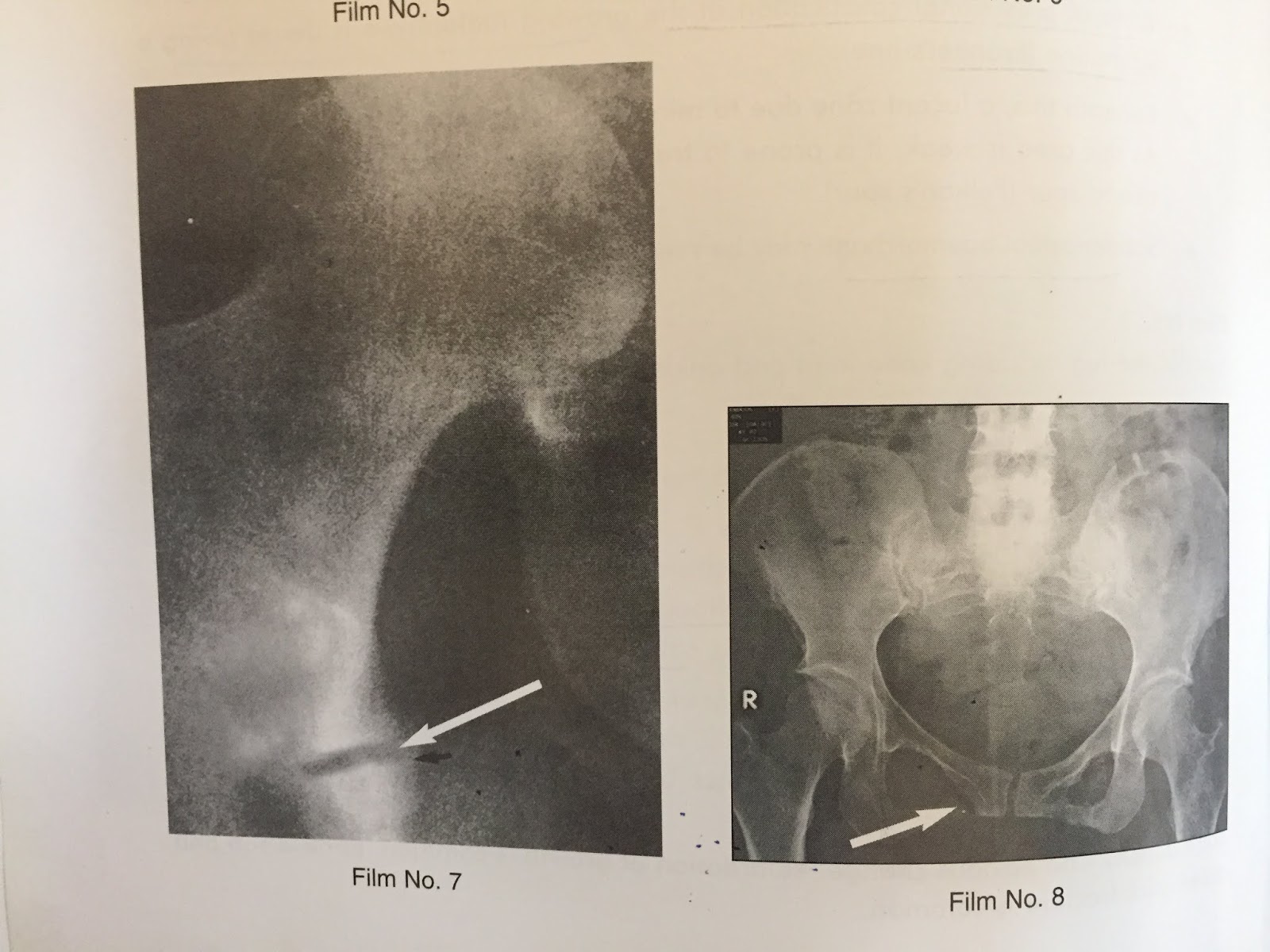 XRAYS OF RICKETS DISEASE
