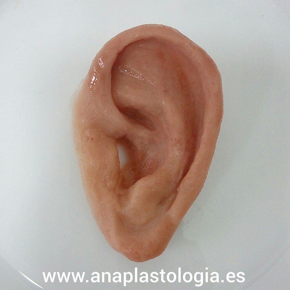 Anaplastologia: Prótesis auricular