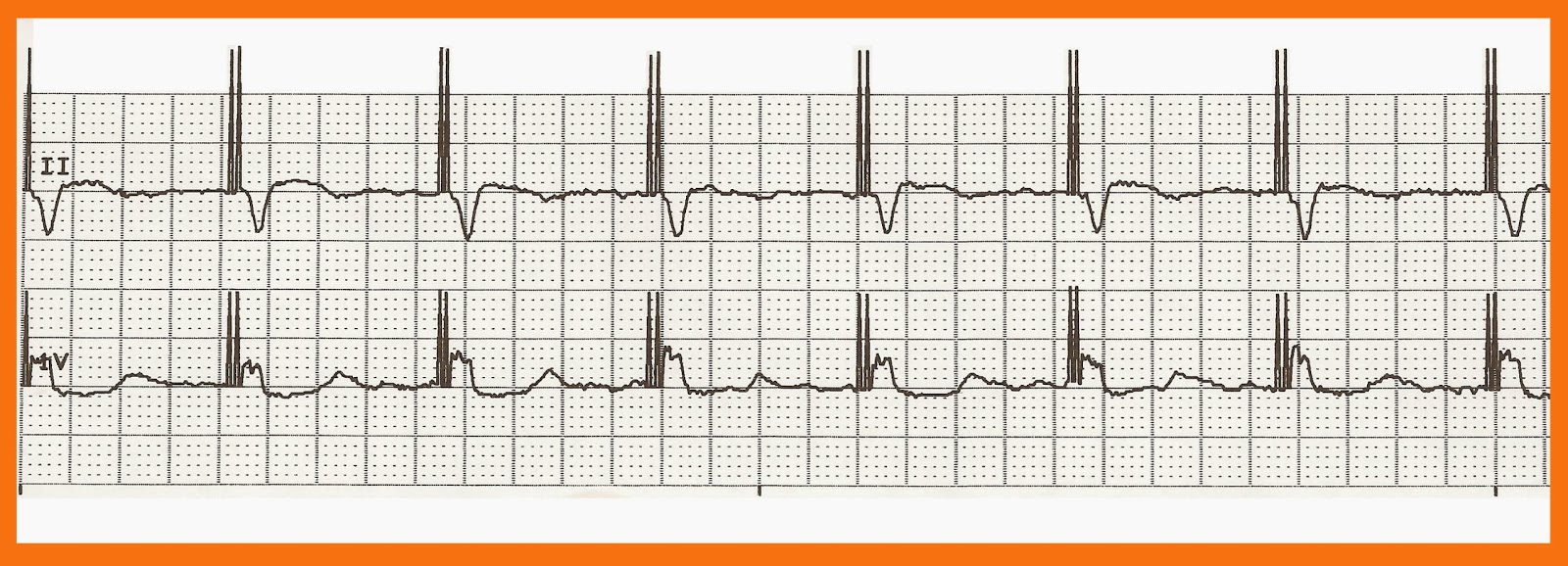 EKG Rhythm Strip Quiz 211