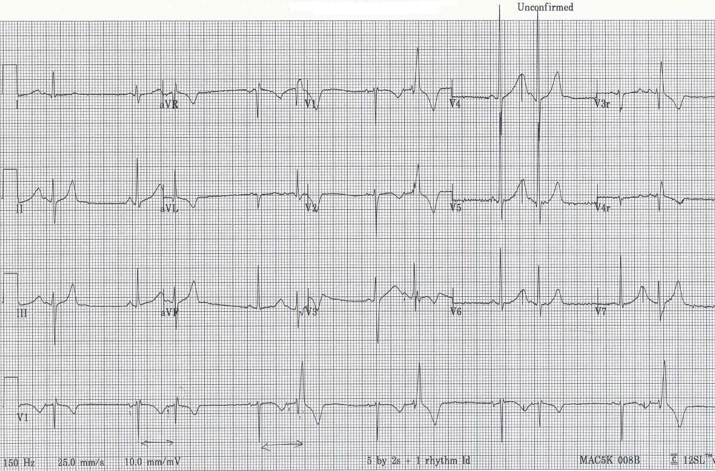 Pedi cardiology: Interpret this: EKG - Rhythm strip