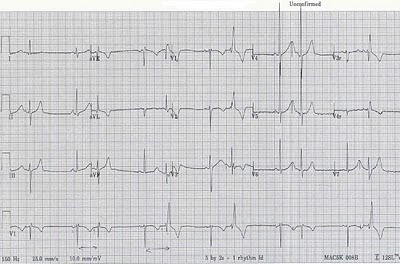 Pedi cardiology: Interpret this: EKG - Rhythm strip
