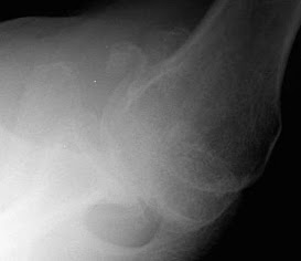 UW Shoulder and Elbow Academy: The ream and run glenohumeral arthroplasty