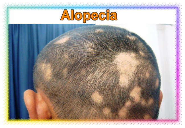 Alopecia - Sure Developers Team