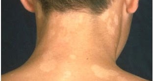 Jenis Penyakit Kulit Lengkap dengan Gambar dan Pengobatannya ...