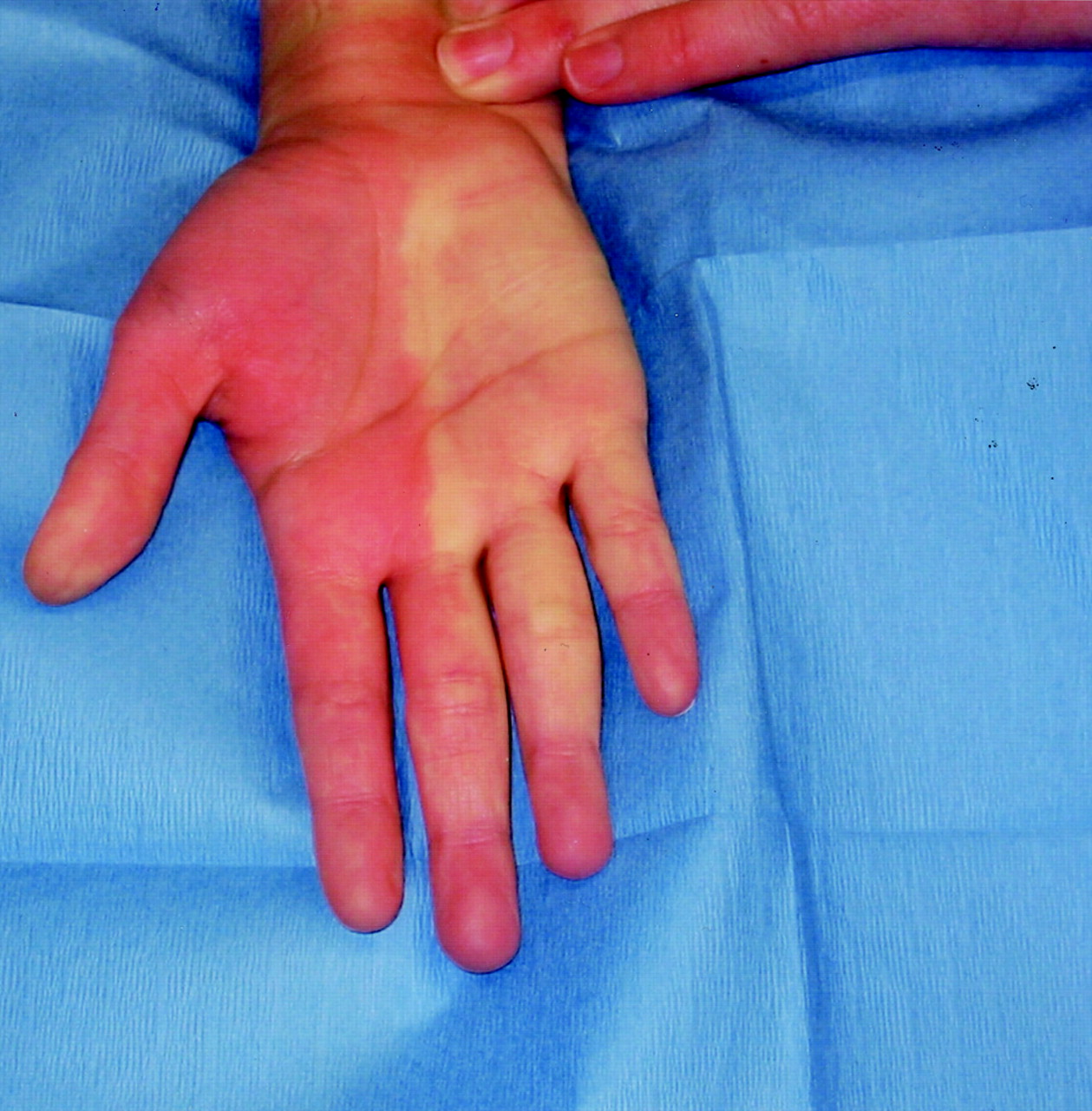 cxlxmxrx: Images of positive Allen test due to lack of collateral ...