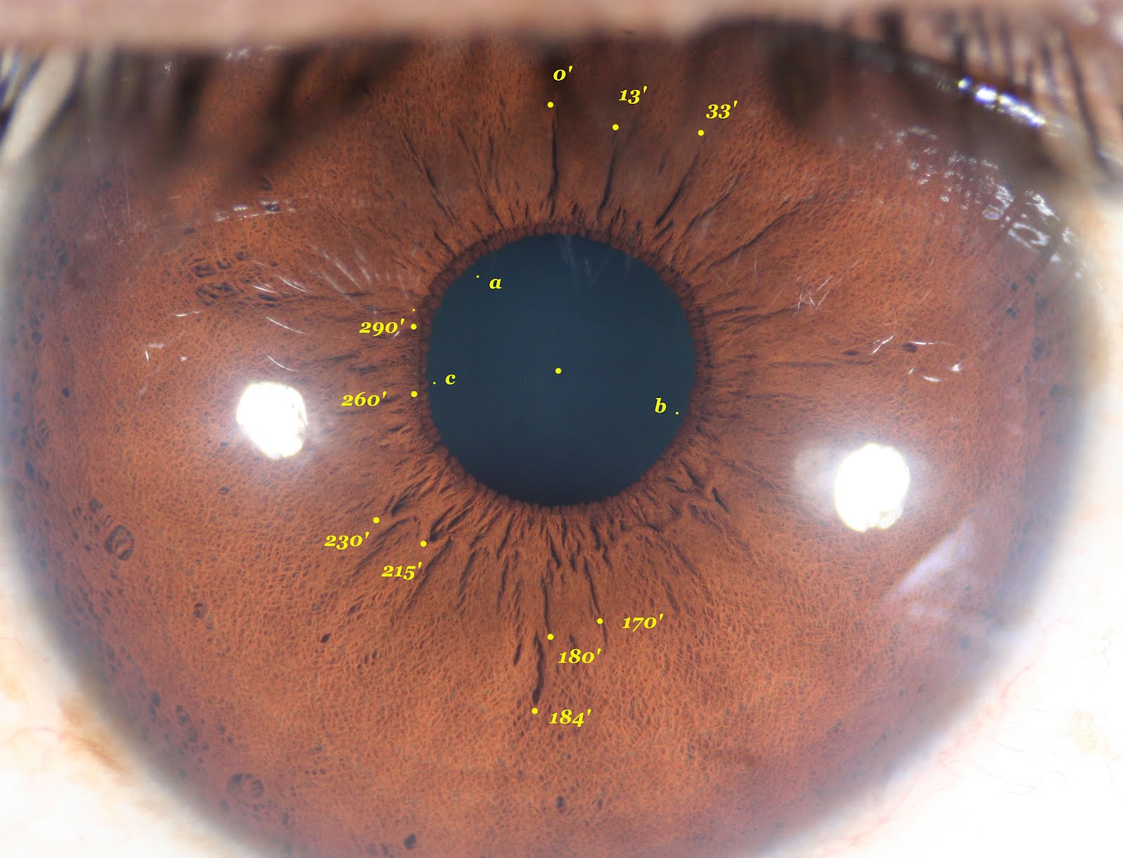 Modern & Multidimensional Iridology: Pupil Flattening, Extroflession ...