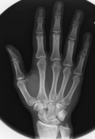 Cicle mitjà: Els ossos de la mà.