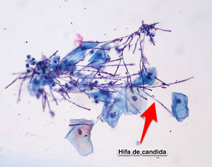 Citología Exfoliativa Mérida: Cándida sp. Qué es la candidiasis?