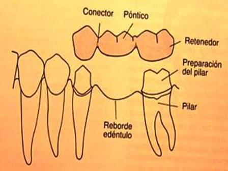 PROTESIS DENTAL : PONTICO