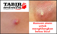 Ramuan Alami Untuk Menghilangkan Bekas Luka Bisul ~ Tabir Wanita