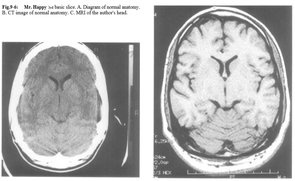 Konsultasi Dokter Keluarga: Cara Mudah Baca CT Scan Kepala