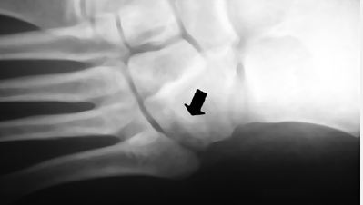 Un médecin du sport vous informe: Fractures du cou et du médio-pied.