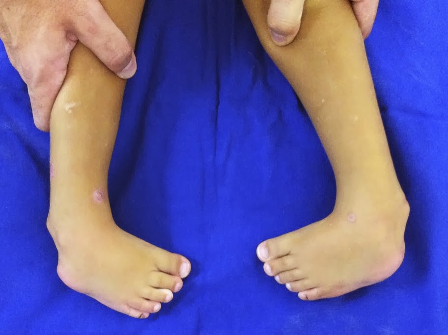 Dr Bruno Massa: Pé torto congênito