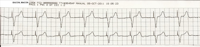 EKG Rhythm Strips 22: Paced Rhythms