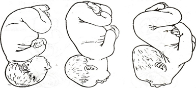 OBSTETRI DIAN HUSADA: Distosia letak dan bentuk janin