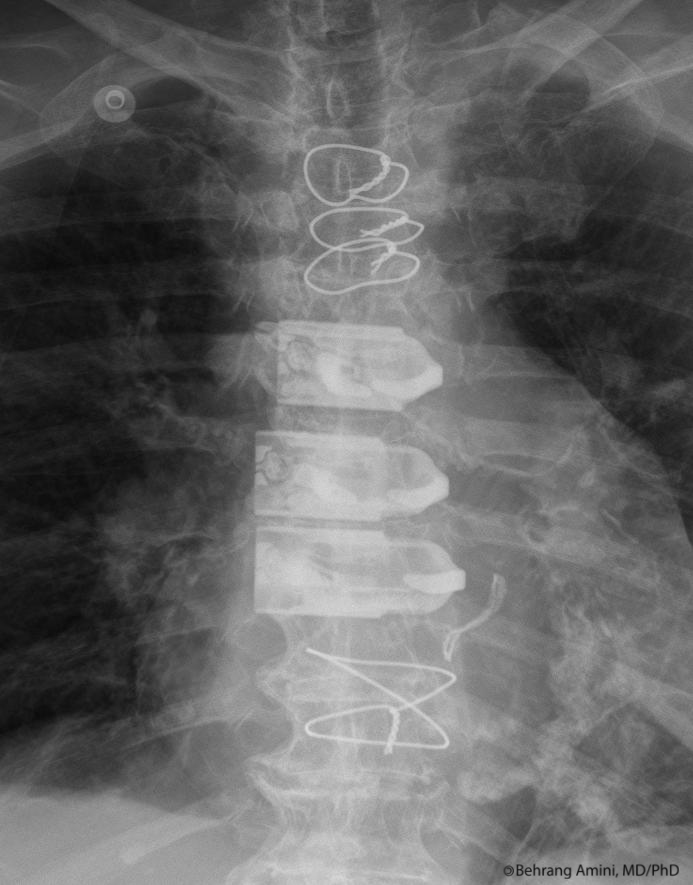 Roentgen Ray Reader: KLS Talon Sternal Closure