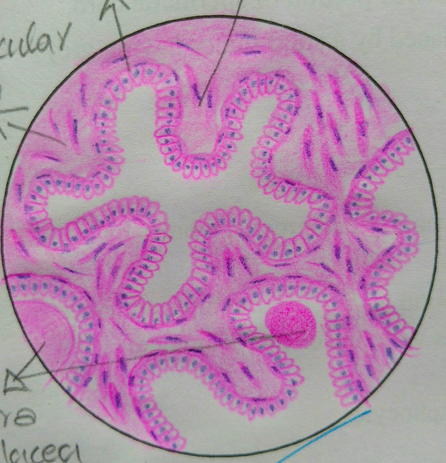 Histopathology Drawings: Benign Prostatic Hypertrophy