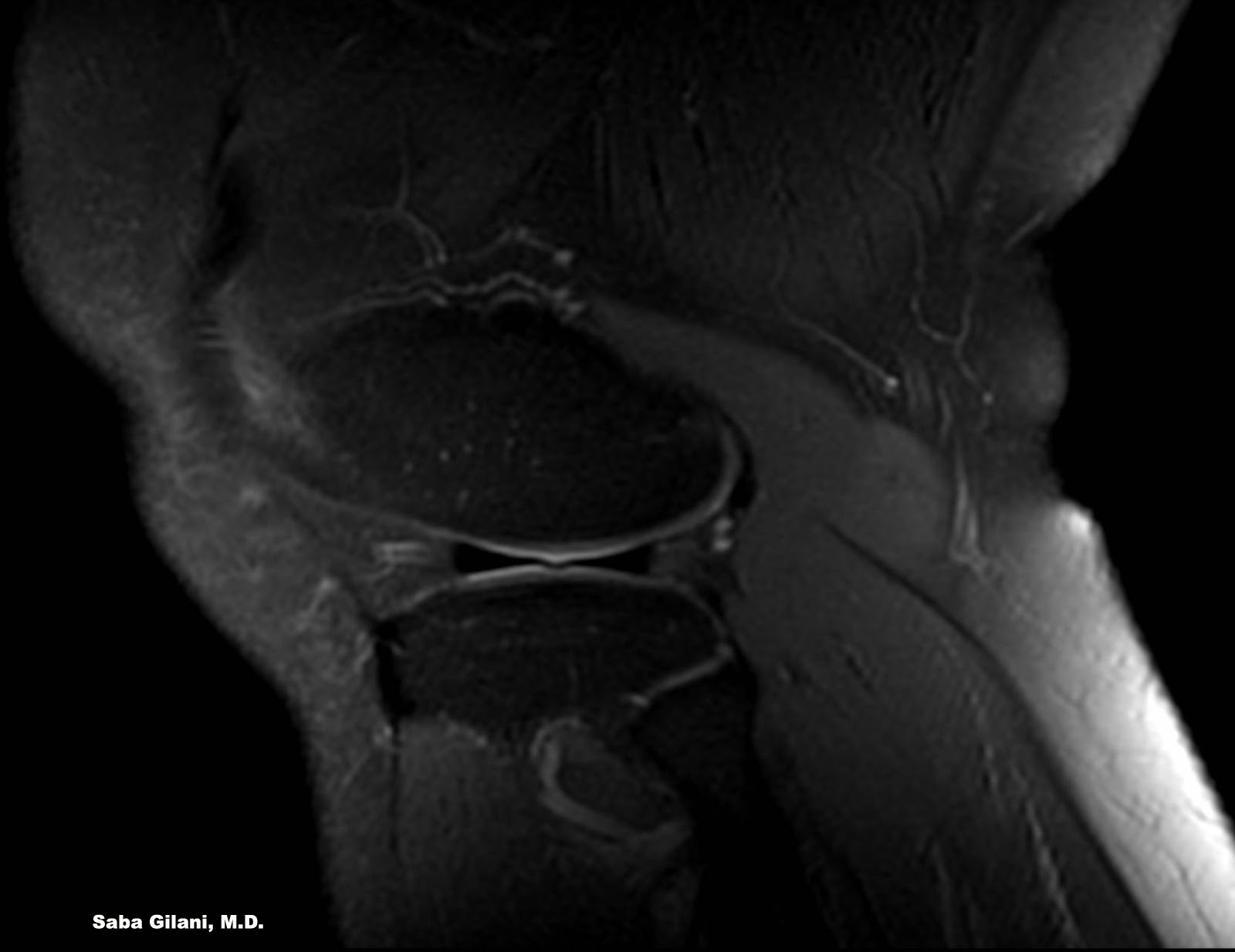 Roentgen Ray Reader: Meniscal Flounce Revisited