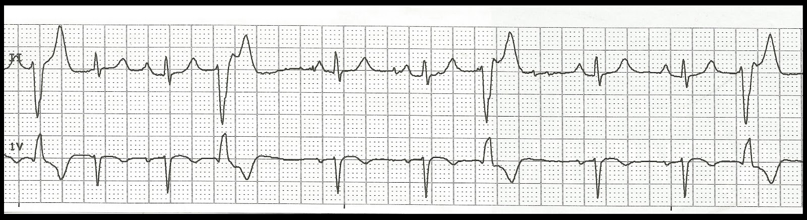 EKG Rhythm Strip Quiz 124