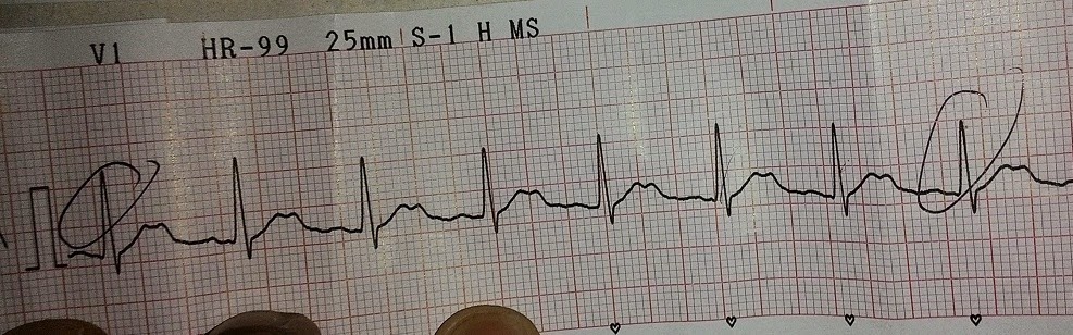 Right Ventricular Hypertrophy (RVH) pada EKG? | SholehShare
