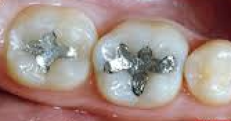 Info if you have silver/black fillings without Symptoms