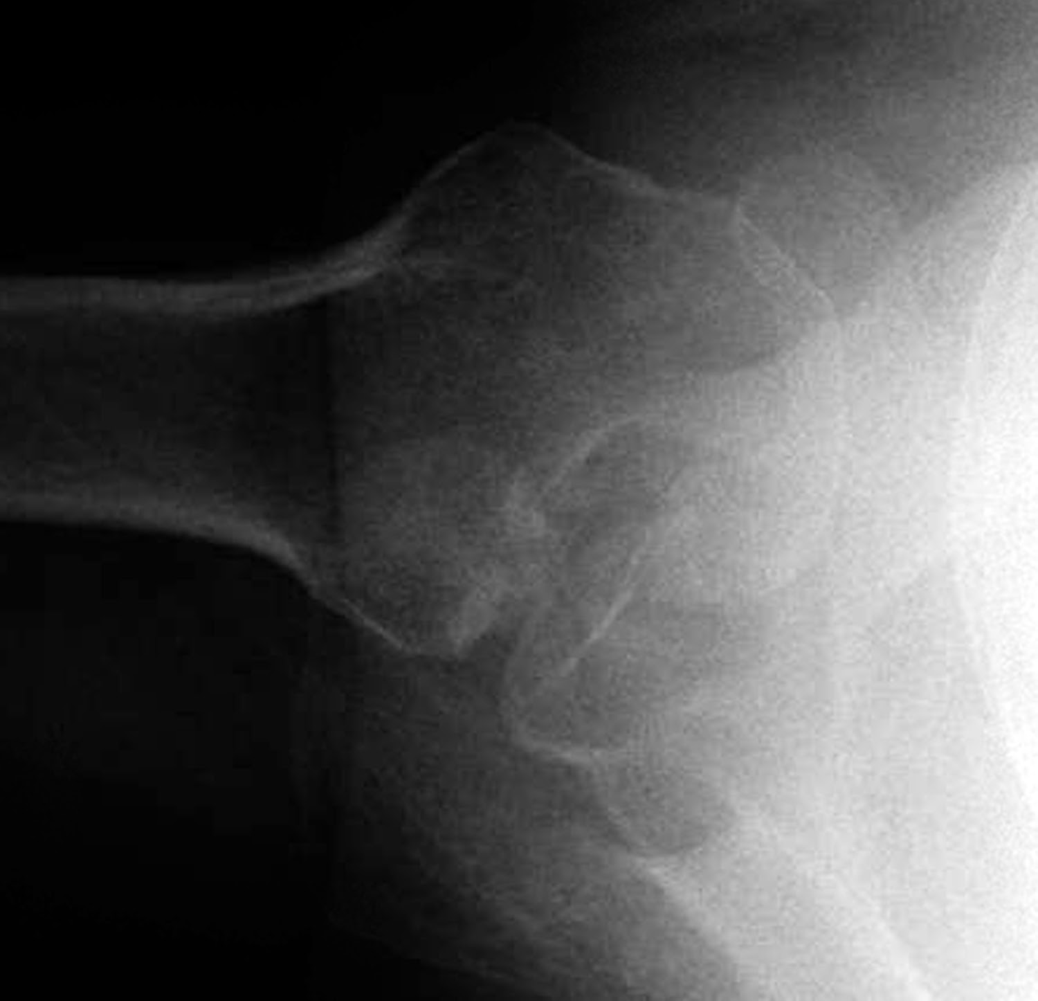 UW Shoulder and Elbow Academy: Shoulder joint replacement - many ...