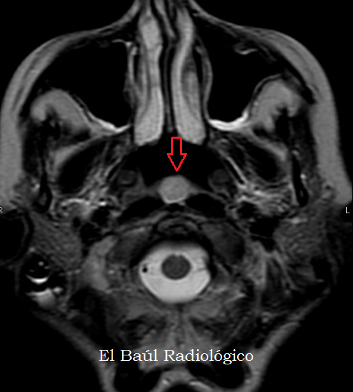 El Baúl Radiológico: QUISTE DE TORNWALDT. BURSA RINOFARÍNGEA (Tornwaldt ...