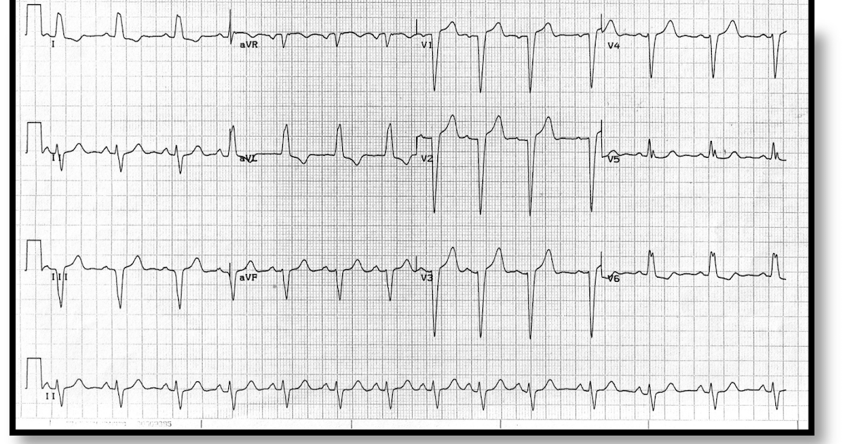 Andrew R. Houghton: Sgarbossa criteria: How to diagnose myocardial ...